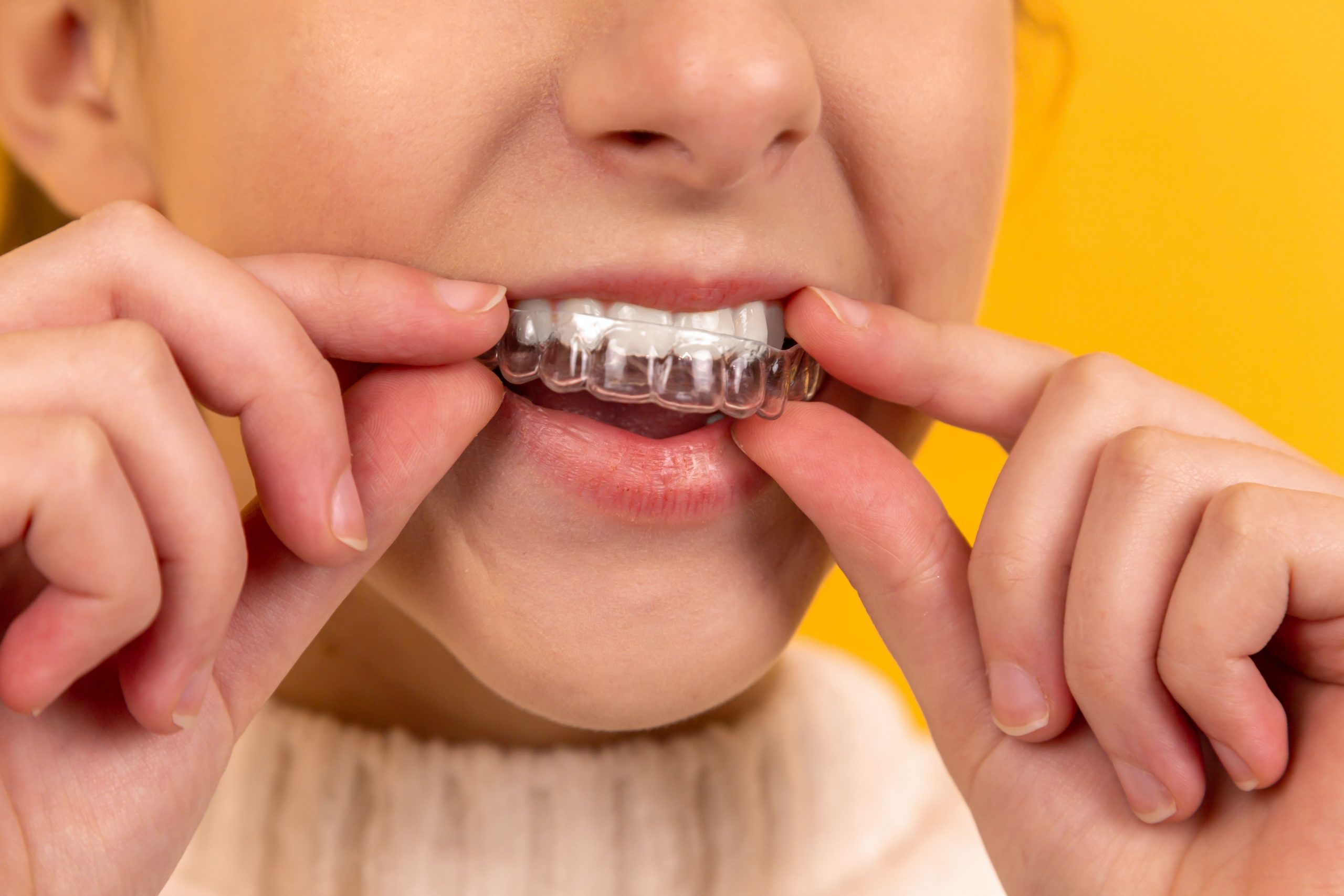 The Possible Benefits Of Teeth Invisalign Sundance Dental And Orthodontics